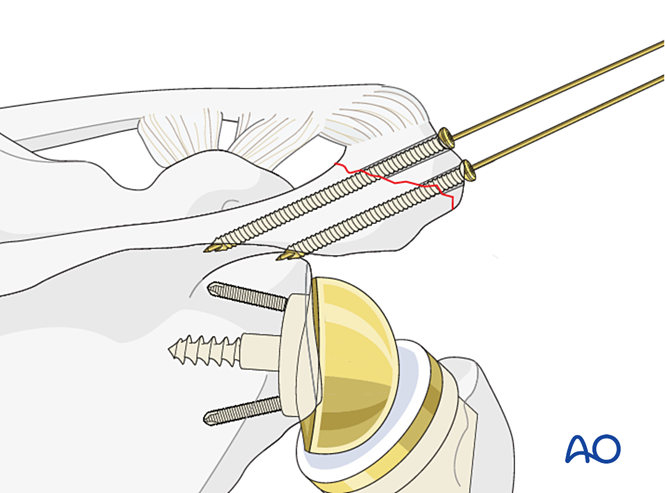 ORIF - Lag screw fixation for Avulsion of the acromion