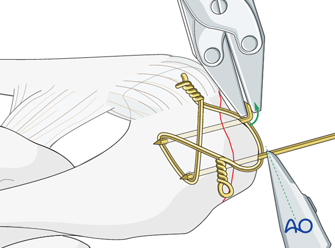 ORIF - Cerclage compression wiring for Avulsion of the acromion