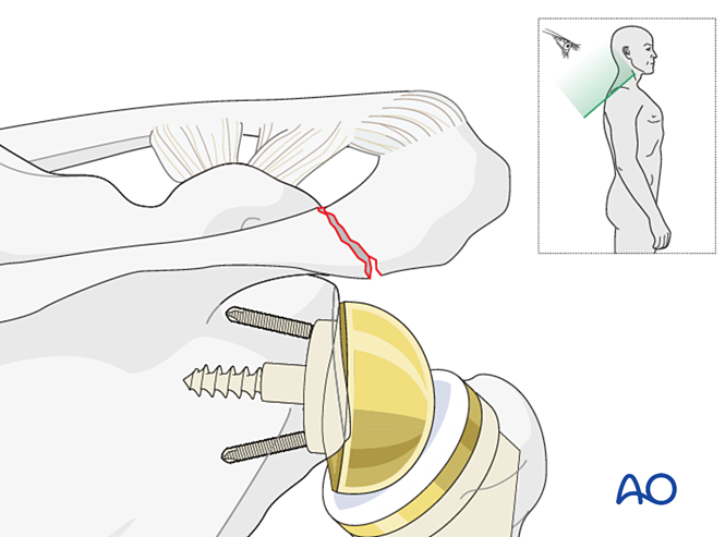 ORIF - Reconstruction plate fixation for Avulsion of the acromion