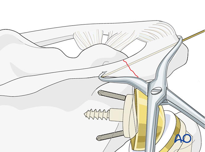 ORIF - Reconstruction plate fixation for Avulsion of the acromion