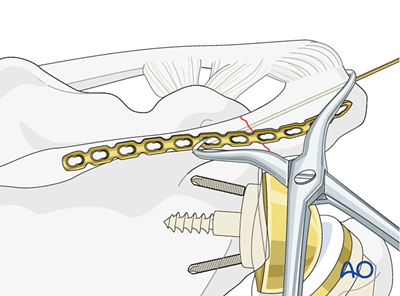 ORIF - Reconstruction plate fixation for Avulsion of the acromion
