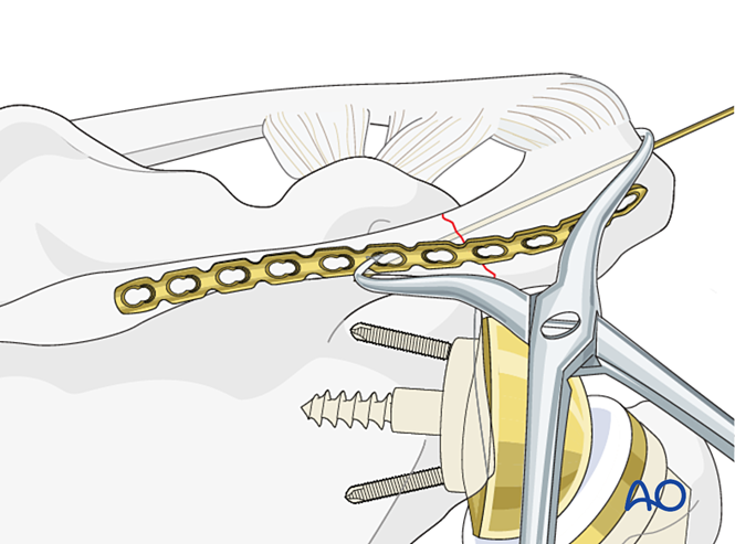 ORIF - Reconstruction plate fixation for Avulsion of the acromion