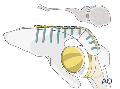 ORIF - Reconstruction plate fixation for Avulsion of the acromion