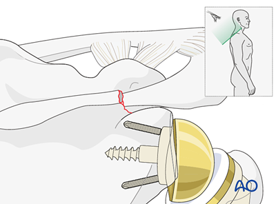 ORIF - Reconstruction plate fixation for Spine of the scapula