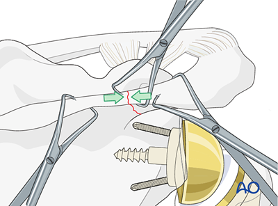 ORIF - Reconstruction plate fixation for Spine of the scapula