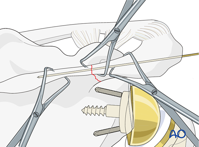ORIF - Reconstruction plate fixation for Spine of the scapula