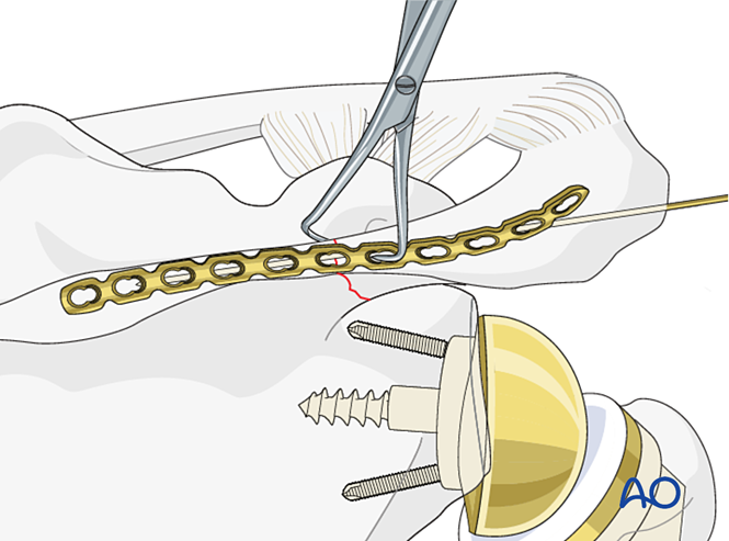 ORIF - Reconstruction plate fixation for Spine of the scapula