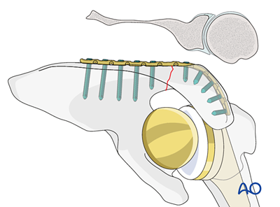 ORIF - Reconstruction plate fixation for Spine of the scapula