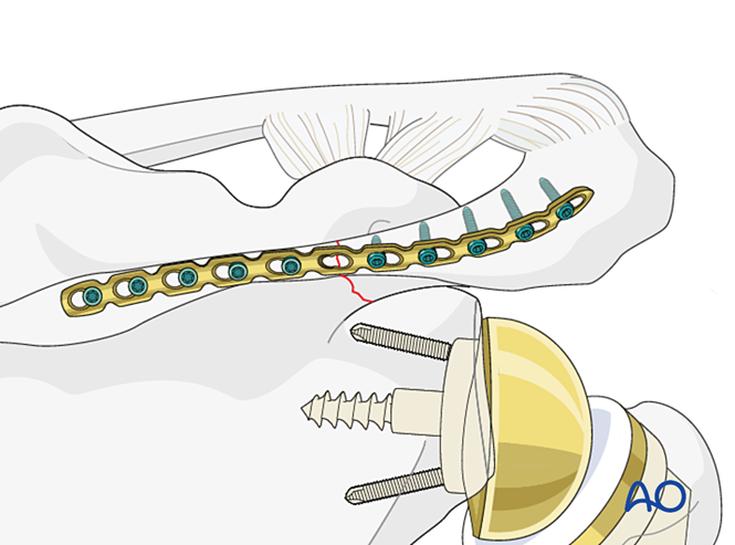 ORIF - Reconstruction plate fixation for Spine of the scapula