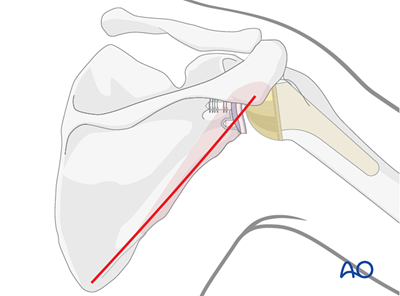 ORIF – plate fixation for Body of the scapula