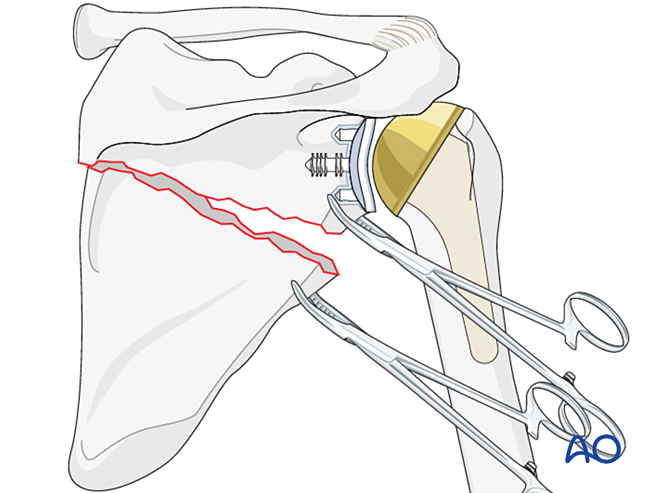 ORIF – plate fixation for Body of the scapula
