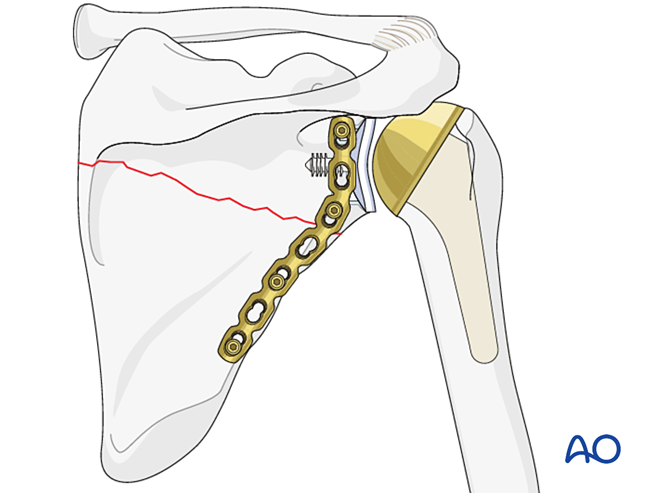 ORIF – plate fixation for Body of the scapula