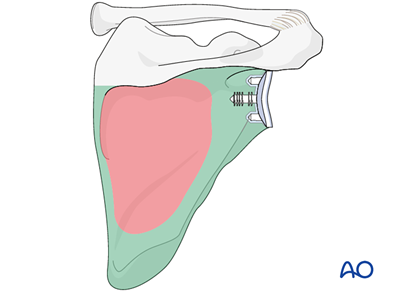 ORIF – plate fixation for Body of the scapula