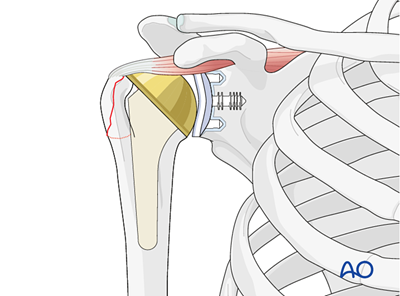 ORIF - Suture or screw fixation for Avulsion of the greater tuberosity