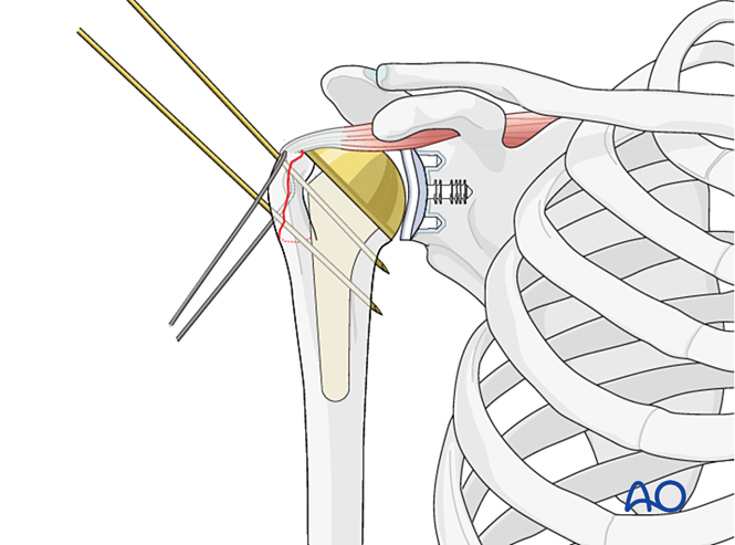 ORIF - Suture or screw fixation for Avulsion of the greater tuberosity
