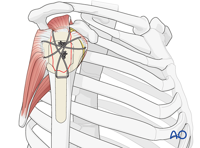 ORIF - Suture or screw fixation for Avulsion of the greater tuberosity
