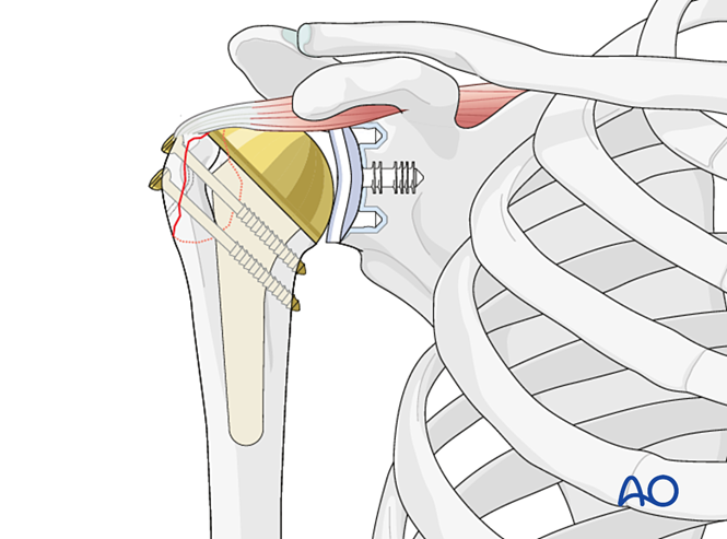 ORIF - Suture or screw fixation for Avulsion of the greater tuberosity