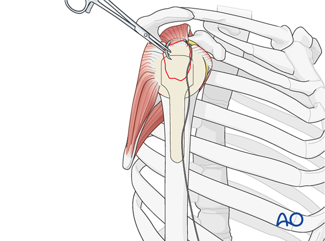 ORIF - Suture or screw fixation for Avulsion of the greater tuberosity