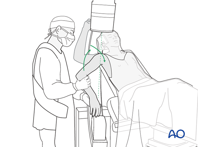 ORIF - Suture or screw fixation for Avulsion of the greater tuberosity