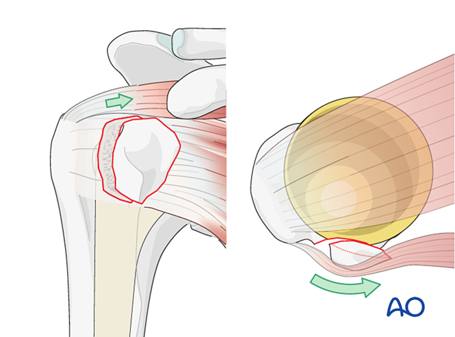 ORIF - Plate fixation for Avulsion of the lesser tuberosity