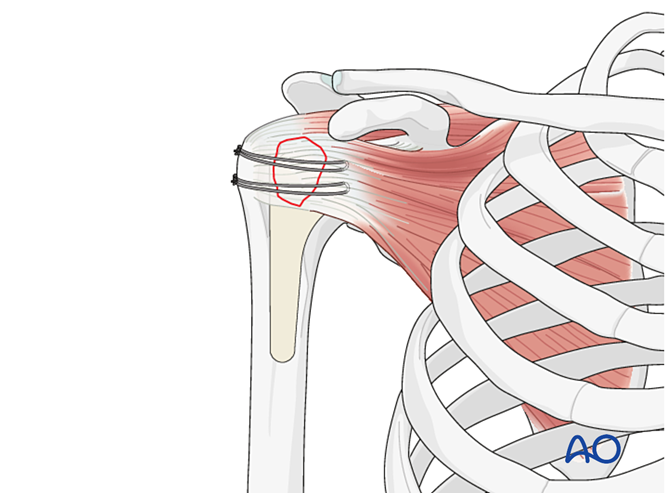 ORIF - Suture or screw fixation for Avulsion of the lesser tuberosity