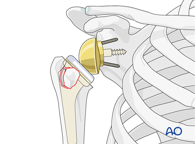 ORIF - Suture or screw fixation for Avulsion of the lesser tuberosity