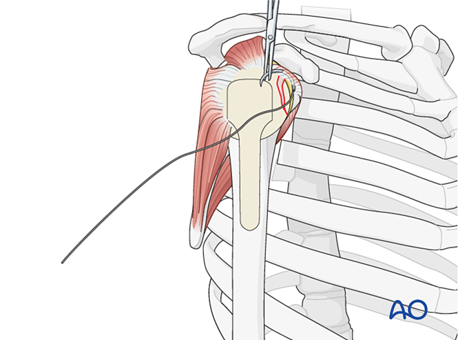 ORIF - Suture or screw fixation for Avulsion of the lesser tuberosity