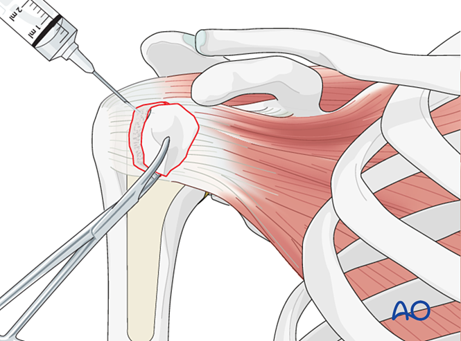 ORIF - Suture or screw fixation for Avulsion of the lesser tuberosity