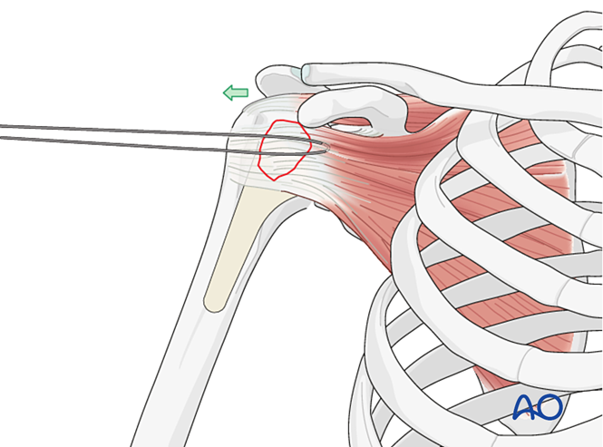 ORIF - Suture or screw fixation for Avulsion of the lesser tuberosity