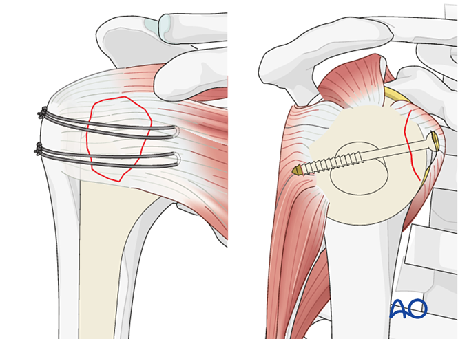 ORIF - Suture or screw fixation for Avulsion of the lesser tuberosity