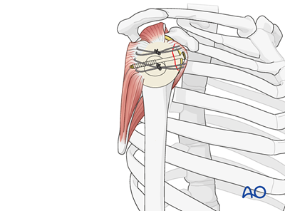 ORIF - Suture or screw fixation for Avulsion of the lesser tuberosity