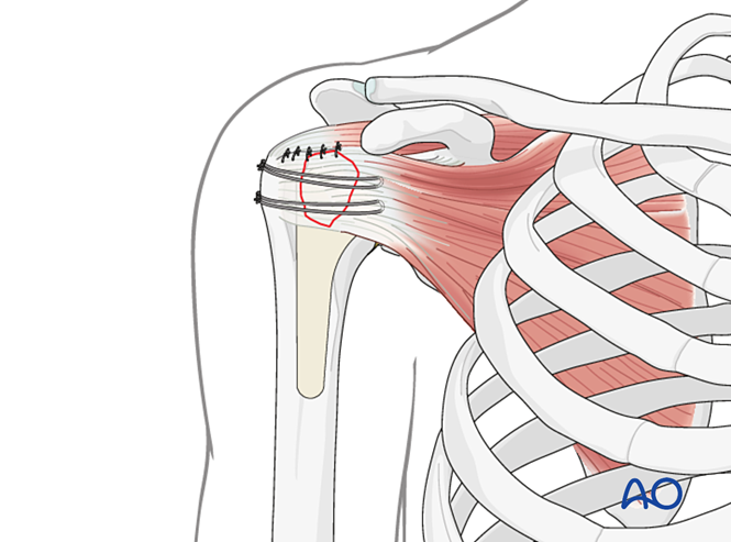 ORIF - Suture or screw fixation for Avulsion of the lesser tuberosity