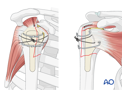 ORIF - Suture or screw fixation for Avulsion of the lesser tuberosity