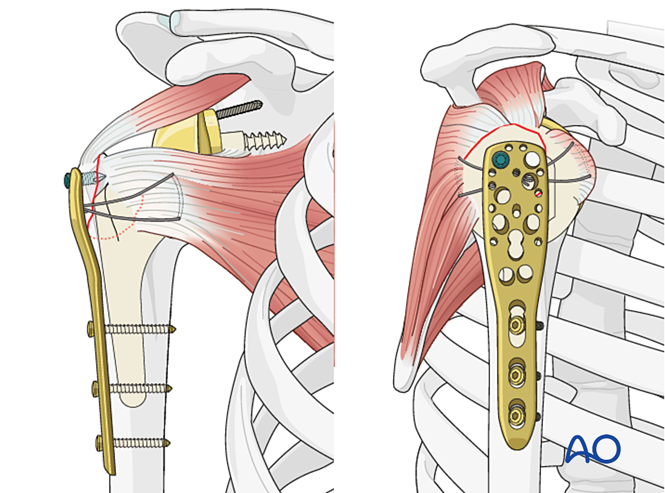 ORIF - Plate fixation for Avulsion of the greater tuberosity