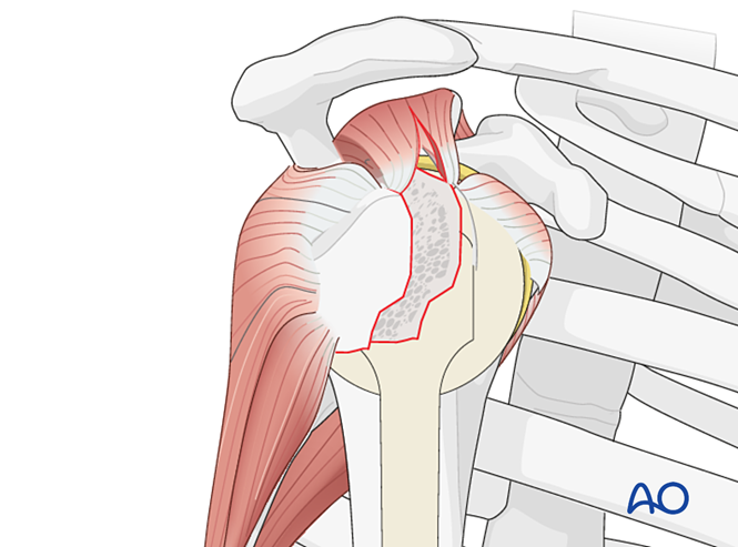 ORIF - Plate fixation for Avulsion of the greater tuberosity