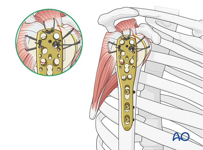 ORIF - Plate fixation for Avulsion of the greater tuberosity