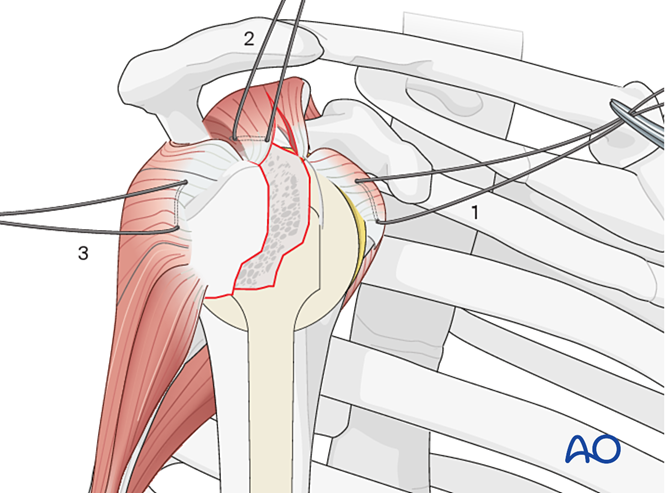 ORIF - Plate fixation for Avulsion of the greater tuberosity
