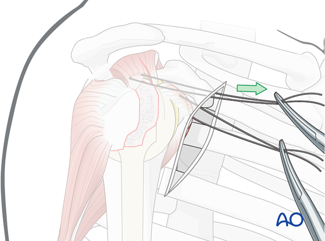ORIF - Plate fixation for Avulsion of the greater tuberosity