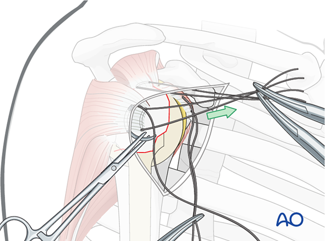 ORIF - Plate fixation for Avulsion of the greater tuberosity