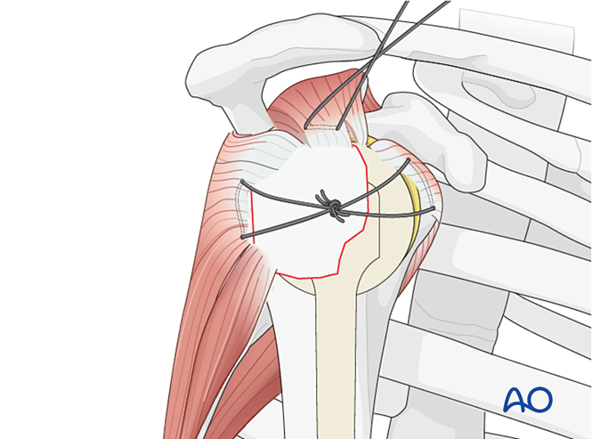 ORIF - Plate fixation for Avulsion of the greater tuberosity