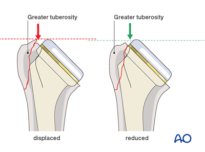 ORIF - Plate fixation for Avulsion of the greater tuberosity