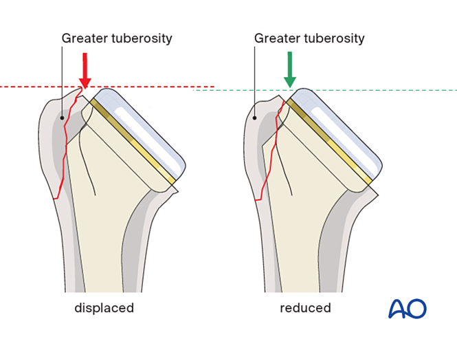 ORIF - Plate fixation for Avulsion of the greater tuberosity