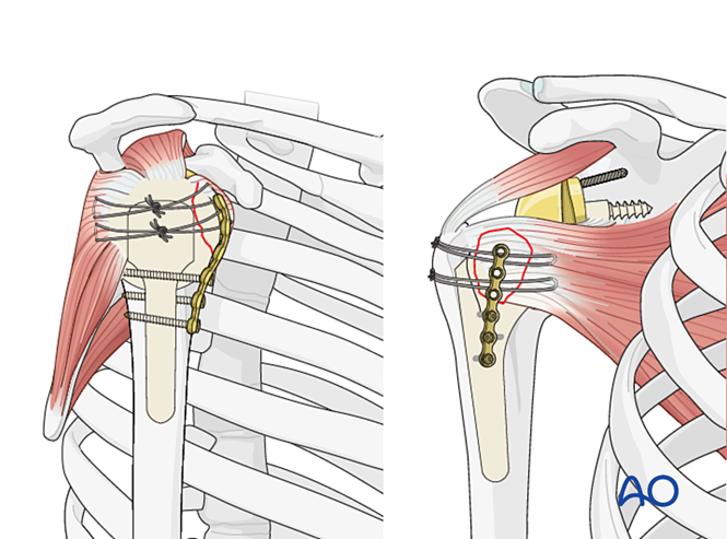 ORIF - Plate fixation for Avulsion of the lesser tuberosity