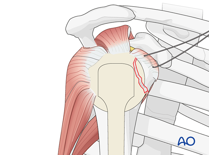 ORIF - Plate fixation for Avulsion of the lesser tuberosity