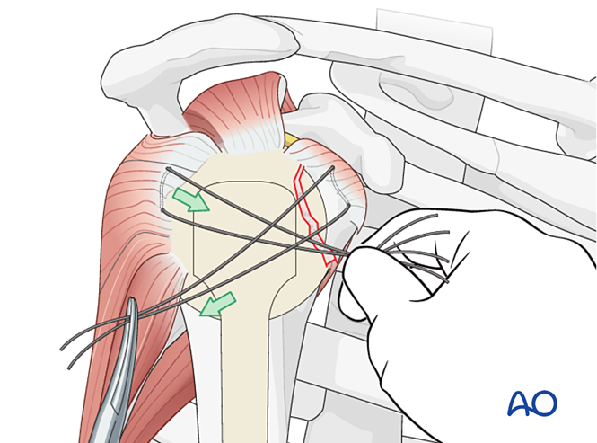 ORIF - Plate fixation for Avulsion of the lesser tuberosity