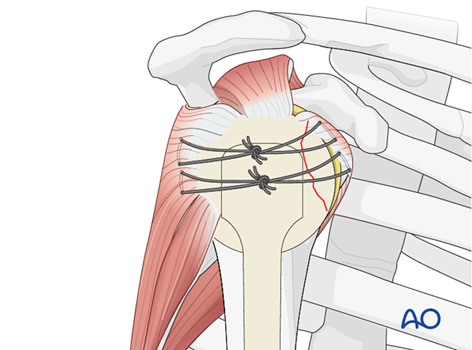 ORIF - Plate fixation for Avulsion of the lesser tuberosity