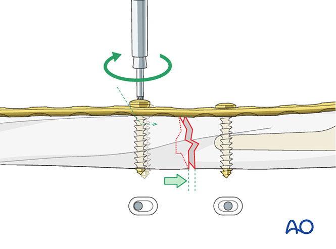 ORIF - Lag screw with plate fixation for Fracture distal to the implant