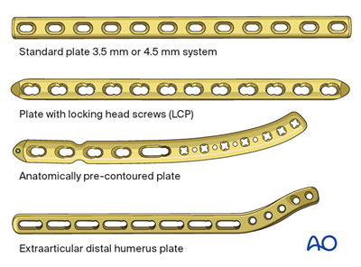 ORIF - Lag screw with plate fixation for Fracture distal to the implant