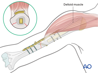 ORIF - Lag screw with plate fixation for Fracture distal to the implant