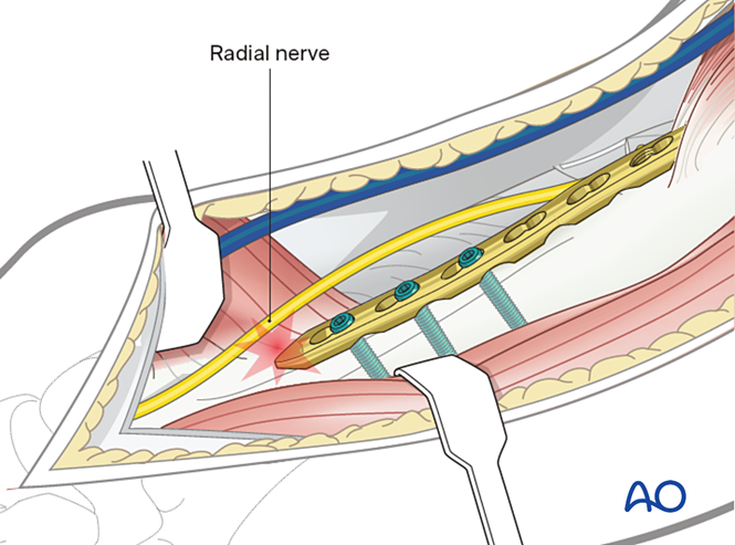 ORIF - Bridge plate fixation for Humeral implant stable, good bone